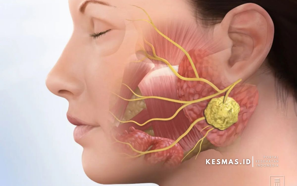 Penyakit Kelenjar Air Liur yang Perlu Dikenali