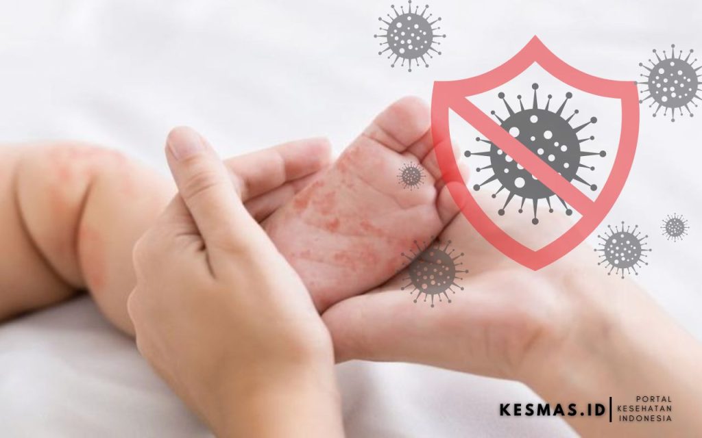 Penyakit Campak: Gejala, Pencegahan, dan Pentingnya Imunisasi